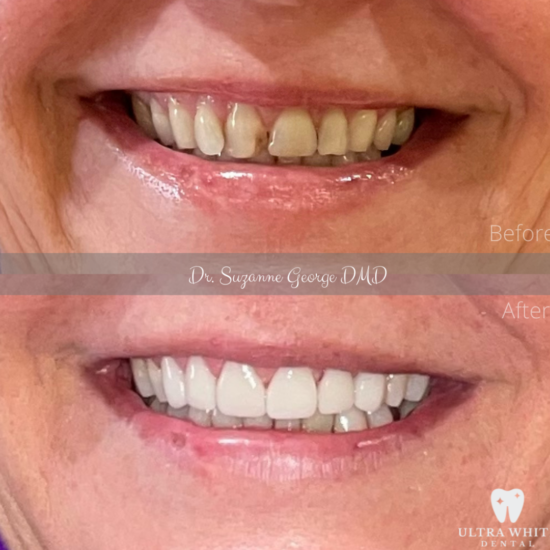 Free Virtual Veneer Consultation - Ultra White Dental Clinic