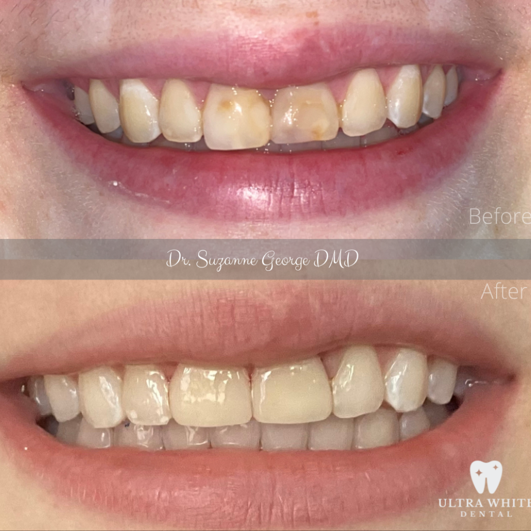 Free Virtual Veneer Consultation - Ultra White Dental Clinic